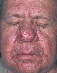 ROSÁCEA: Vermelhidão no Rosto - Causas e Tratamento ⋆ Orientação Médica ...